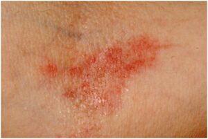 Rashes – Atlantic Dermatology